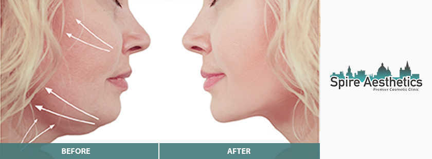 Non Surgical Double Chin Treatment York